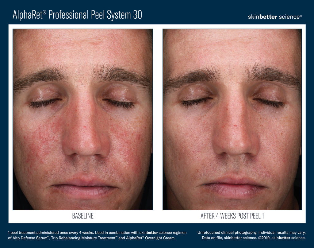 AlphaRet® Professional Peel System 30 – AestheticSource