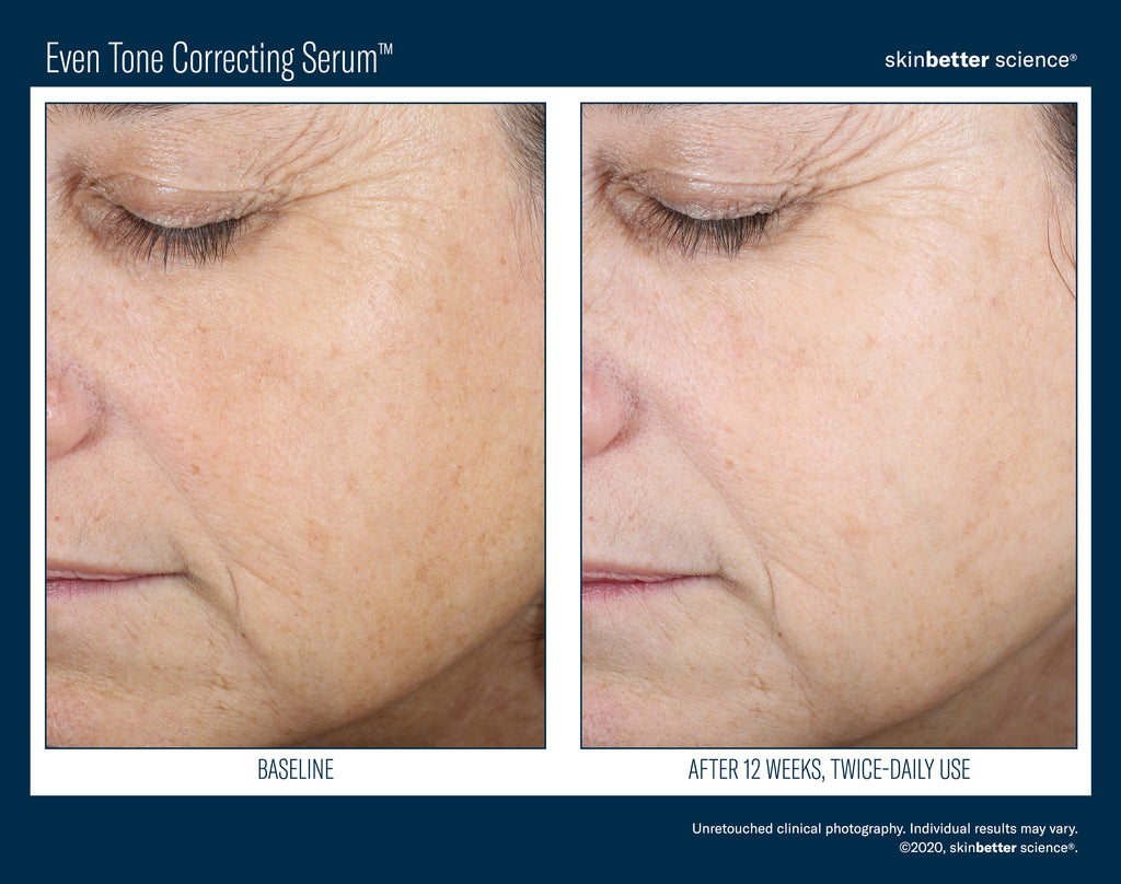 Even Tone Correcting Serum™ – AestheticSource